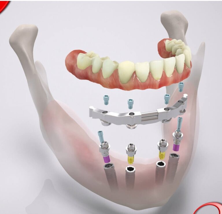 Protocolo Branemark com Carga Imediata - Clinica Dr. Dal